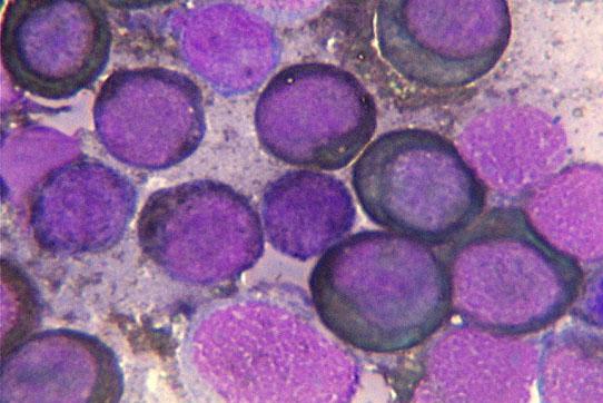 AML M4 FAB: Akute myelomonozytäre Leukämie - Bildserie 1