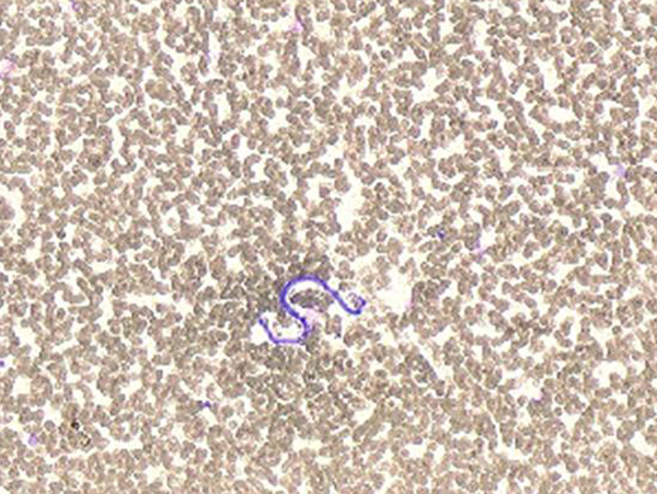 Bildserie: Loa-loa-Filariose mit Befall des Blutes und des rechten Auges